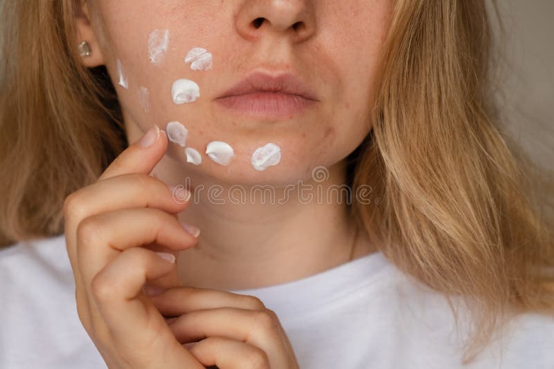Unrecognizable Woman Applies Makeup Cream Serum Cure For Acne On Face