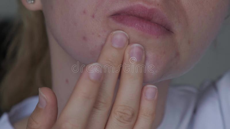 Rash On The Skin Of A Man In The Groin Area The Concept Of Venereal Diseases Stock Video