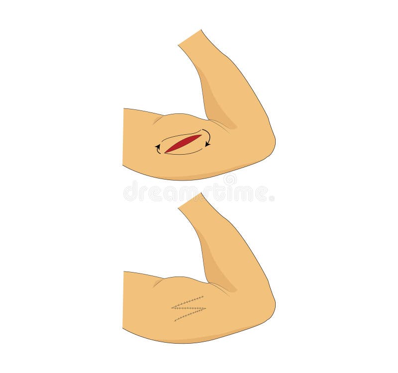 Tissue Transfers Stock Illustrations – 2 Tissue Transfers Stock ...