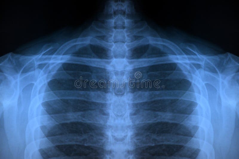 Upper Body X-Ray stock image. Image of diagnosis, care - 13510281