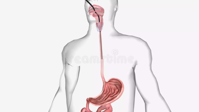 An Upper Endoscopy or EGD is an Invasive Procedure Used To Look Inside ...