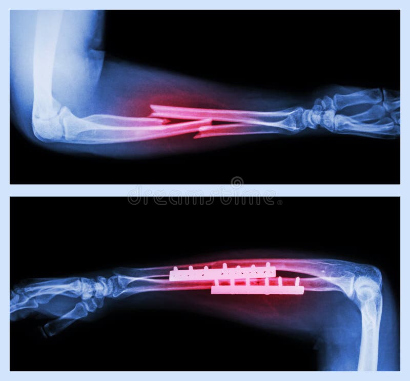 Upper Image : Fracture Ulnar and Radius (Forearm Bone) , Lower Image ...