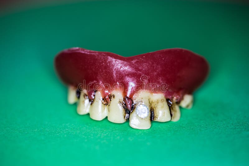 Upper jaw prosthesis stock image. Image of prosthetics - 192985173