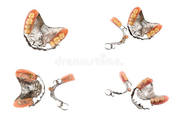 Upper and Lower Partial Metal Removable Dentures Set Stock Image ...