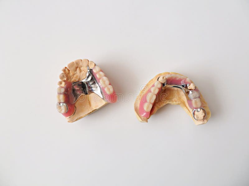 Upper and Lower Removable Partial Denture Stock Photo - Image of ...