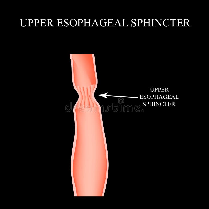 Upper Esophageal Sphincter Dysfunction