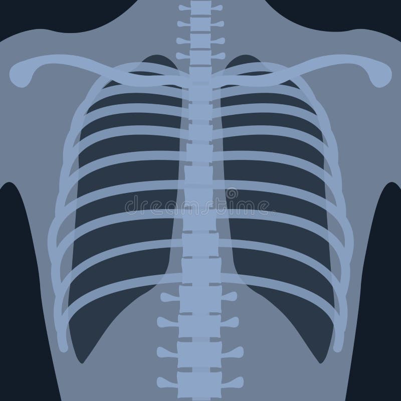 Upright Chest X-Ray for Medical Research and Teaching. Stock Vector ...