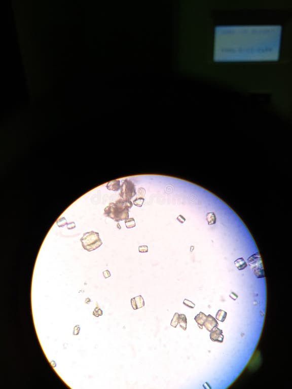Uric Acid Crystals in Urine Microscopic Stock Photo - Image of uric ...