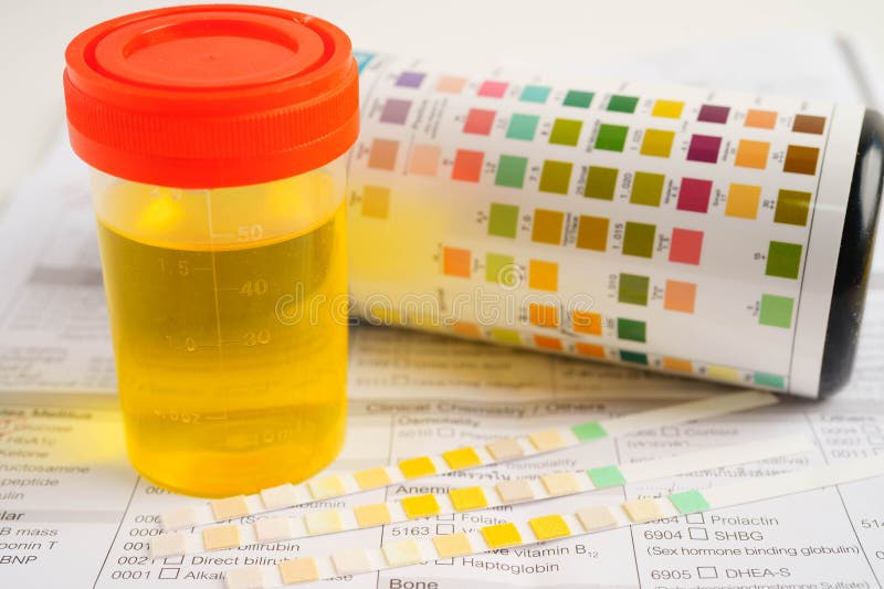 Urinalysis, Urine Cup for Check Health Examination in Laboratory Stock ...