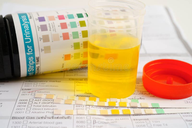 Urinalysis, Urine Cup for Check Health Examination in Laboratory Stock ...