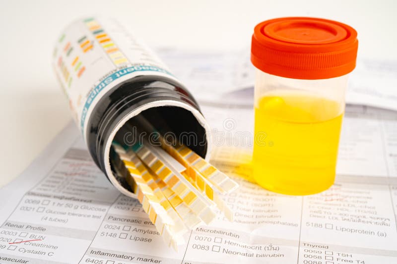 Urinalysis, Urine Cup with Reagent Strip PH Paper Test and Comparison ...