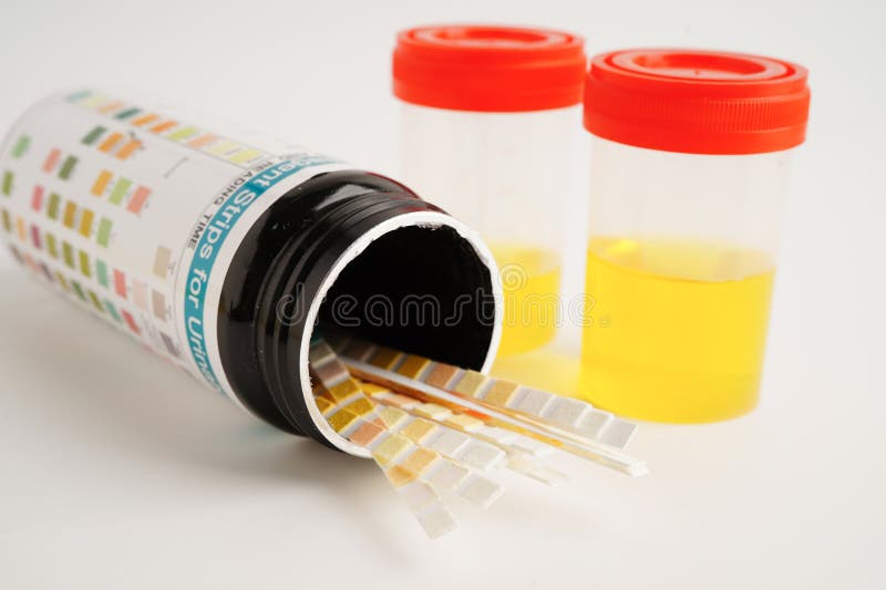 Urinalysis, Urine Cup with Reagent Strip PH Paper Test and Comparison ...
