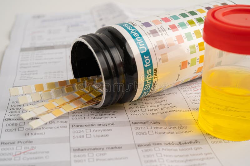 Urinalysis, Urine Cup with Reagent Strip PH Paper Test and Comparison ...