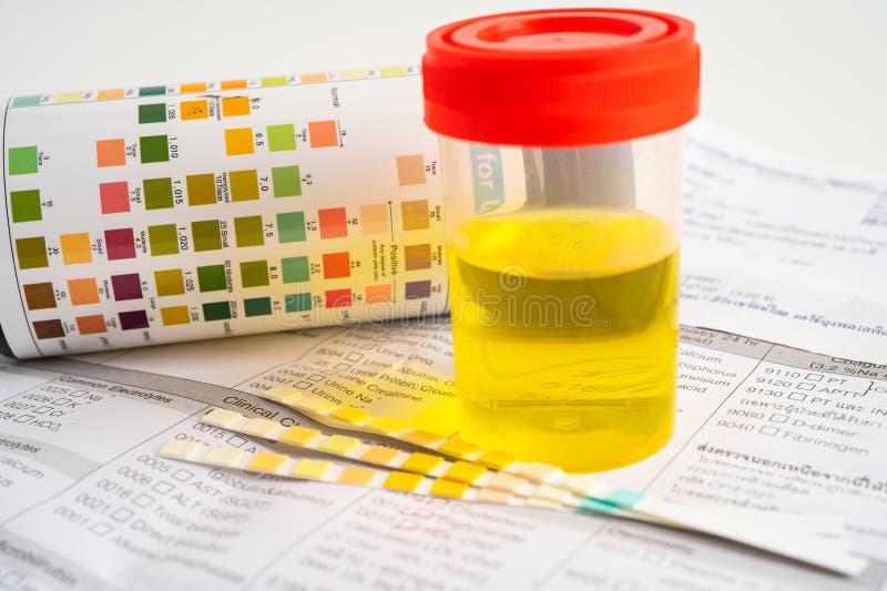 Urinalysis, Urine Cup with Reagent Strip PH Paper Test and Comparison ...