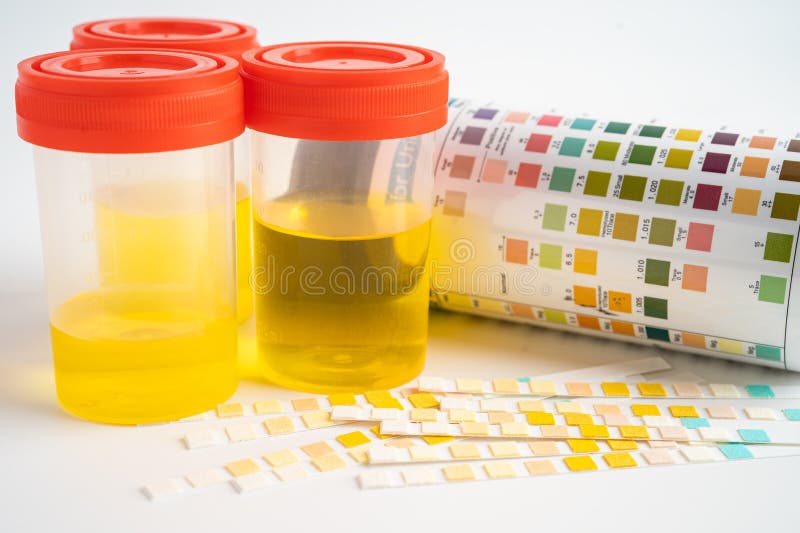 Urinalysis, Urine Cup with Reagent Strip PH Paper Test and Comparison ...