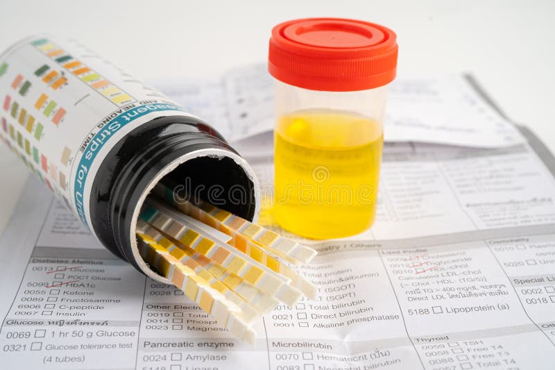 Urinalysis, Urine Cup with Reagent Strip PH Paper Test and Comparison ...