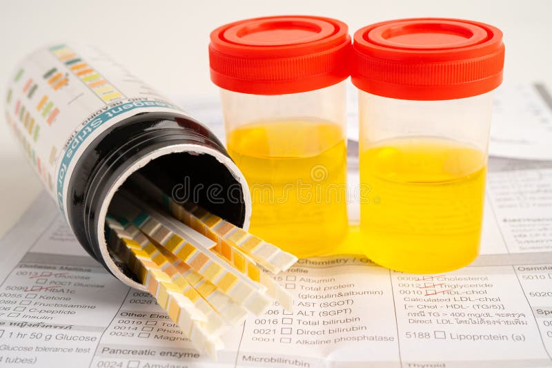 Urinalysis, Urine Cup with Reagent Strip PH Paper Test and Comparison ...