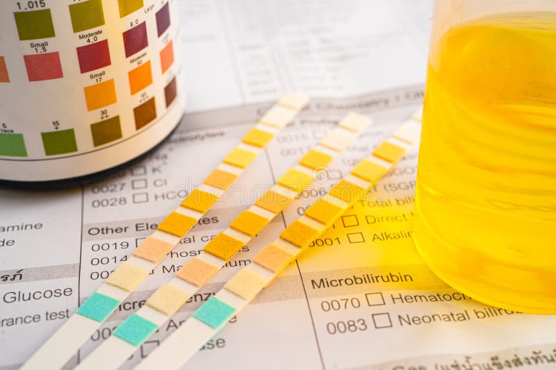Urinalysis, Urine Cup with Reagent Strip PH Paper Test and Comparison ...