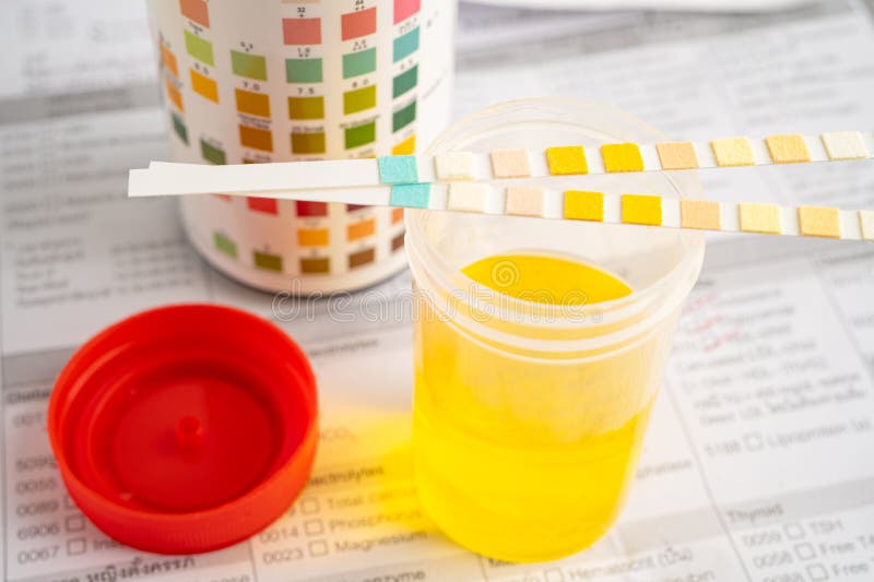 Urinalysis, Urine Cup with Reagent Strip PH Paper Test and Comparison ...