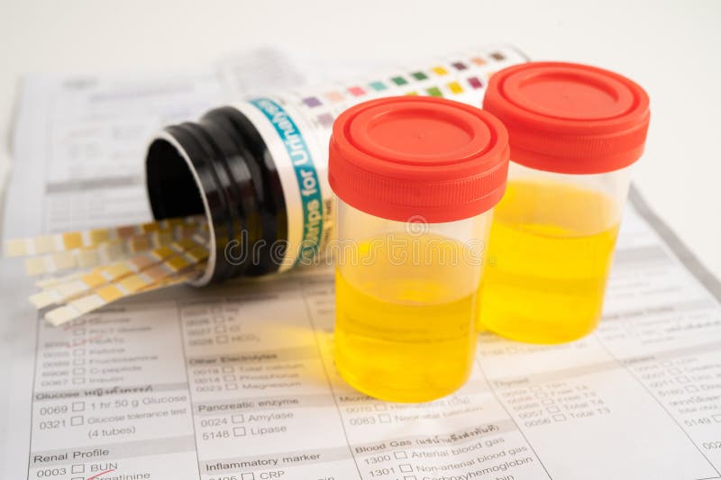 Urinalysis, Kidney Model and Urine Cup with Reagent Strip PH Paper Test ...
