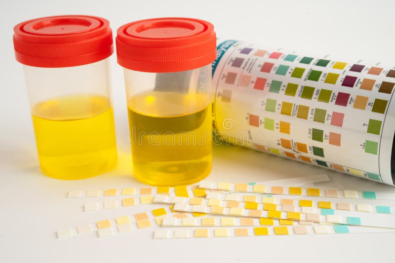 Urinalysis, Urine Cup with Reagent Strip PH Paper Test and Comparison ...