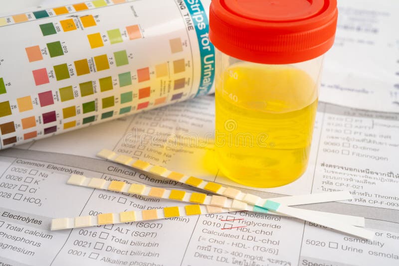 Urinalysis, Urine Cup with Reagent Strip PH Paper Test and Comparison ...