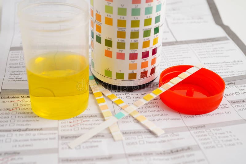 Urinalysis, Urine Cup with Reagent Strip PH Paper Test and Comparison ...