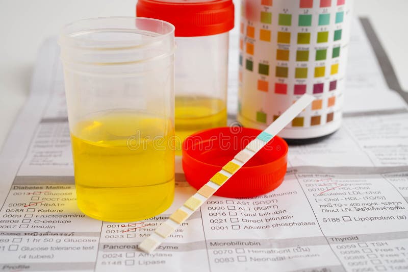 Urinalysis, Urine Cup with Reagent Strip PH Paper Test and Comparison ...