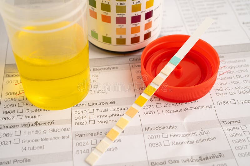 Urinalysis, Urine Cup with Reagent Strip PH Paper Test and Comparison ...
