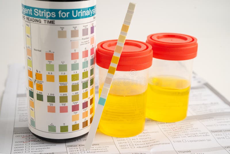 Urinalysis, Urine Cup with Reagent Strip PH Paper Test and Comparison ...