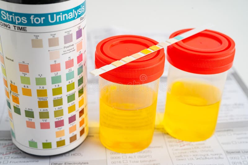 Urinalysis, Urine Cup with Reagent Strip PH Paper Test and Comparison ...