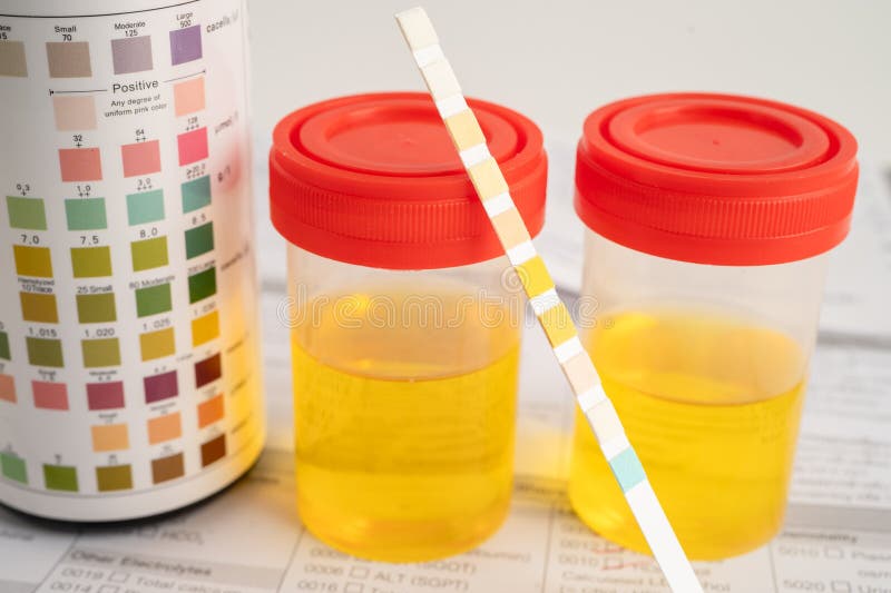 Urinalysis, Urine Cup with Reagent Strip PH Paper Test and Comparison ...