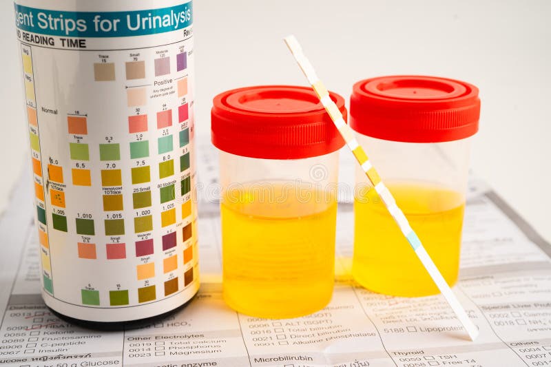 Urinalysis, Urine Cup with Reagent Strip PH Paper Test and Comparison ...