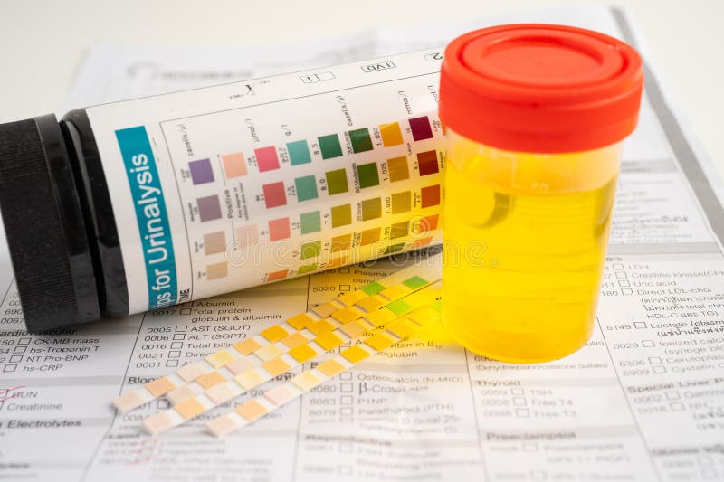 Urinalysis, Urine Cup with Reagent Strip PH Paper Test and Comparison ...