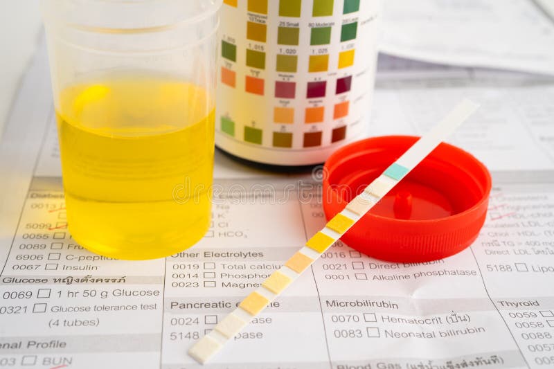 Urinalysis, Urine Cup with Reagent Strip PH Paper Test and Comparison ...