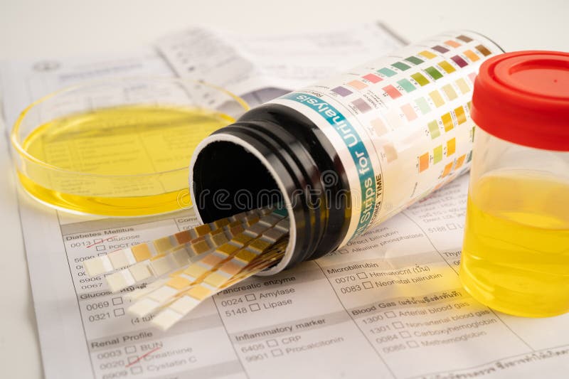 Urinalysis, Urine Cup with Reagent Strip PH Paper Test and Comparison ...