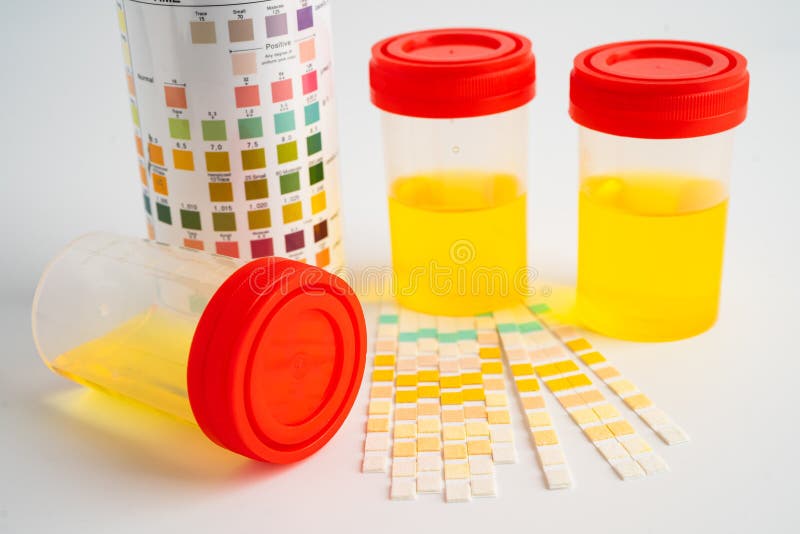 Urinalysis, Urine Cup with Reagent Strip PH Paper Test and Comparison ...