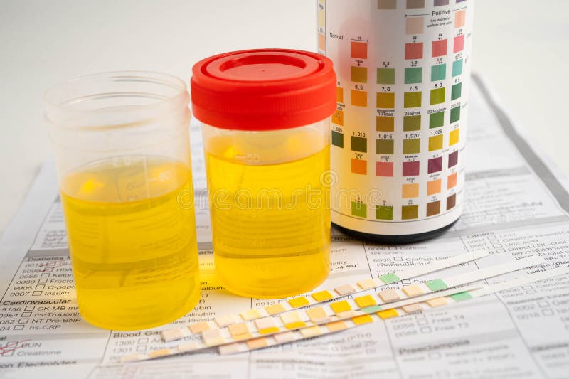Urinalysis, Urine Cup with Reagent Strip PH Paper Test and Comparison ...