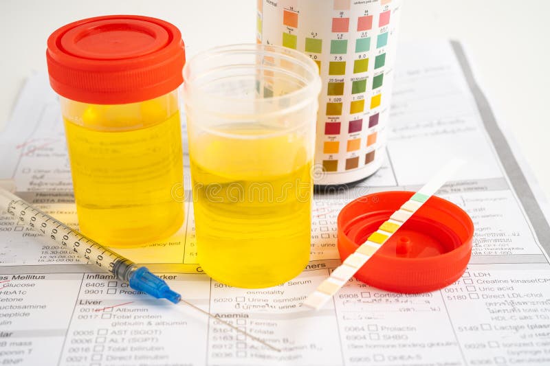 Urinalysis, Urine Cup with Reagent Strip PH Paper Test and Comparison ...