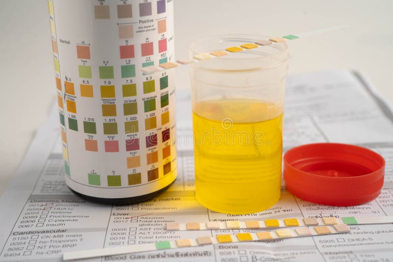 Urinalysis, Urine Cup with Reagent Strip PH Paper Test and Comparison ...