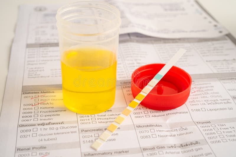 Urinalysis, Urine Cup with Reagent Strip PH Paper Test and Comparison ...