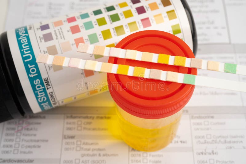 Urinalysis, Urine Cup with Reagent Strip PH Paper Test and Comparison ...