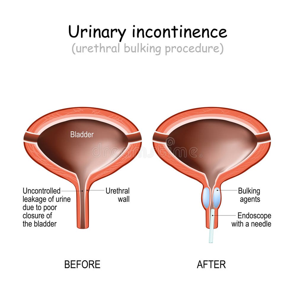 Incontinence Infographic Stock Illustrations 46 Incontinence