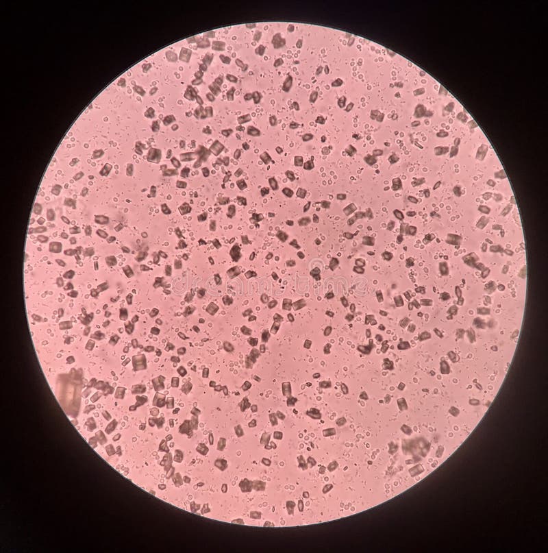 Urine Analysis Finding with Microscope Show Crystal Bacteria and ...