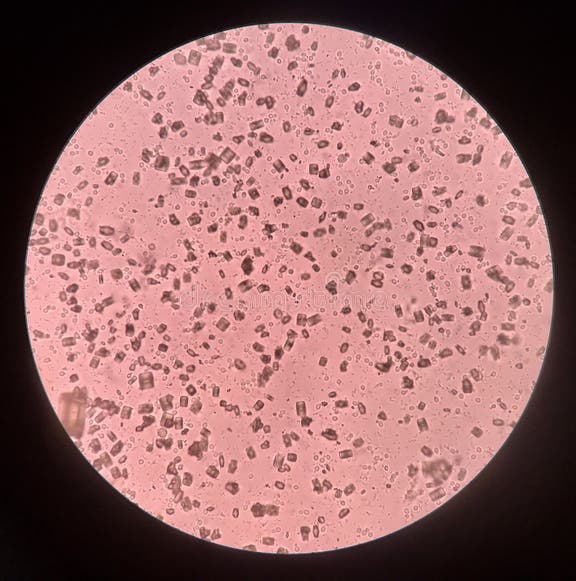Urine Analysis Finding with Microscope Show Crystal Bacteria and ...