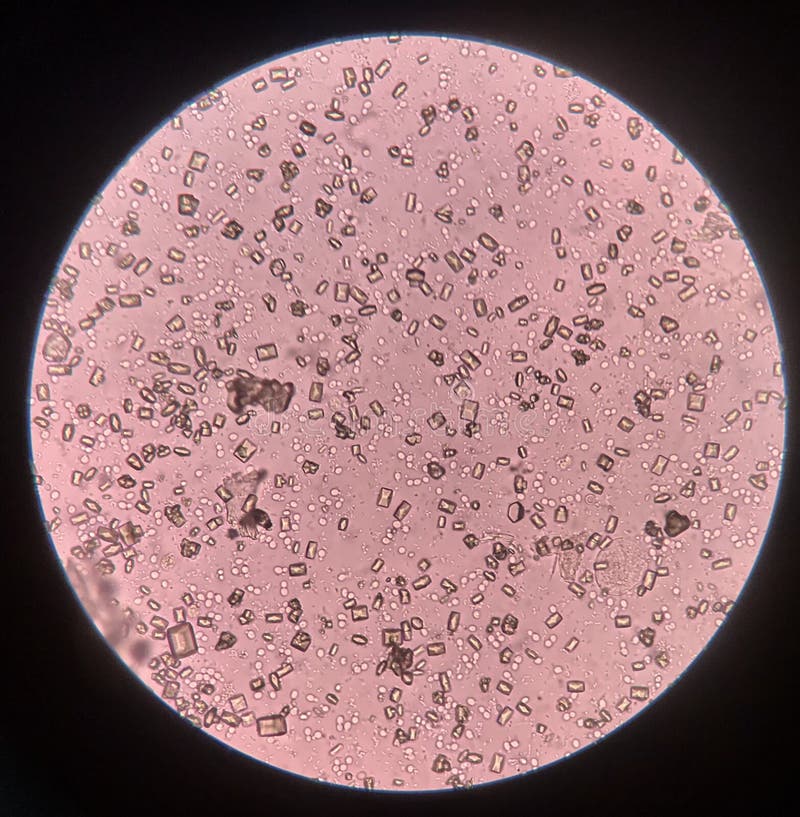 Urine Analysis Finding with Microscope Show Crystal Bacteria and ...