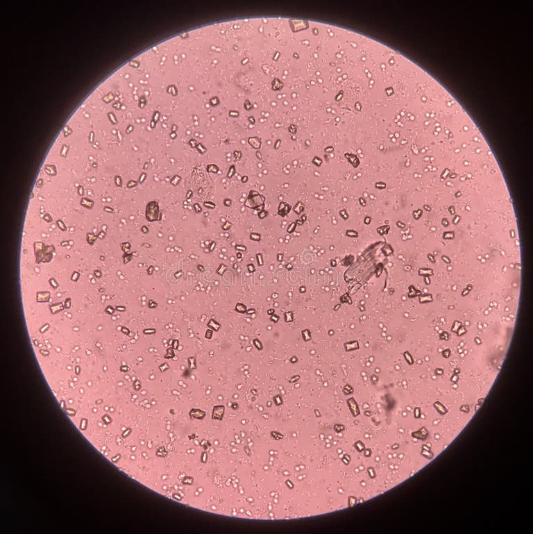 Urine Analysis Finding with Microscope Show Crystal Bacteria and ...