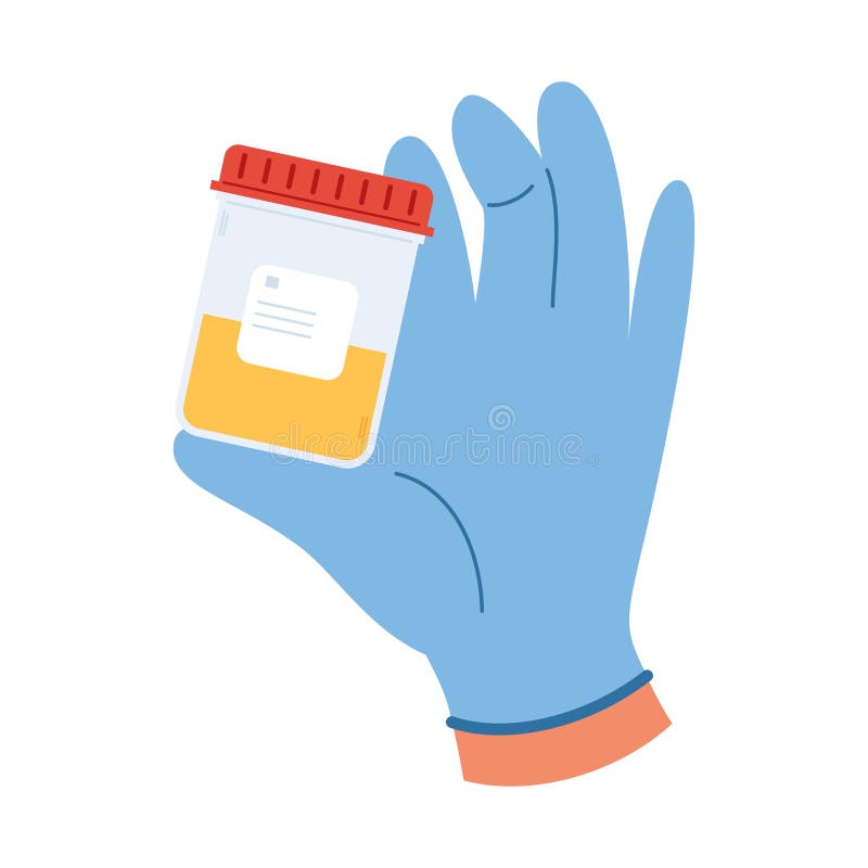 Urine Analysis. Hand in Gloves Holds Container with Urine Sample Stock ...