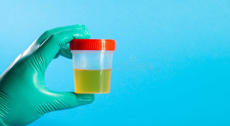Urine Analysis in the Hands of a Doctor Laboratory Assistant on a Blue ...