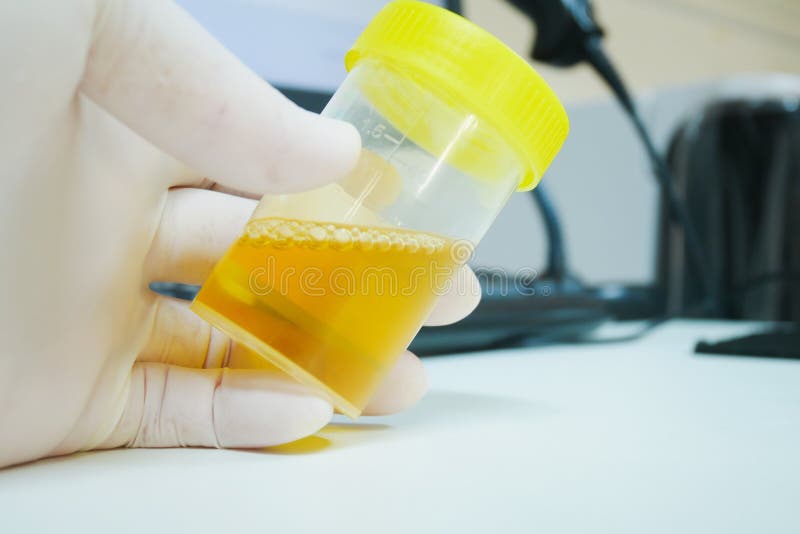 Urine Analysis in Laboratory Stock Photo - Image of filter, kidney: 305999160